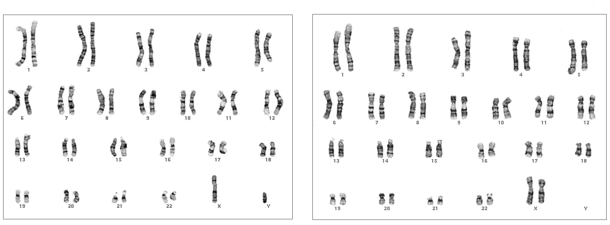 Cromossomos, cariótipos e síndromes cromossômicas - Biologia Enem